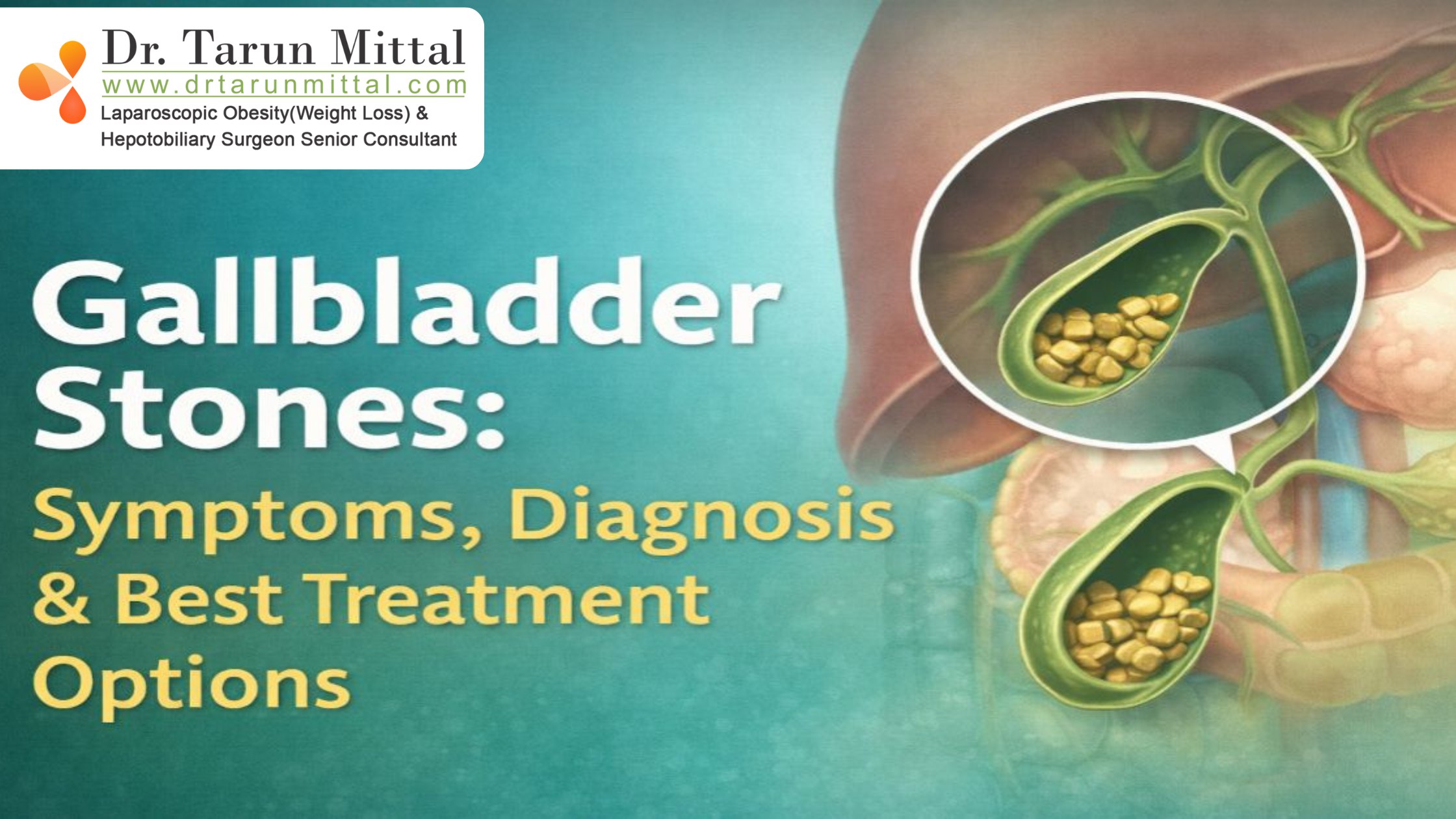 Gallbladder Stones: Symptoms, Diagnosis & Best Treatment Options